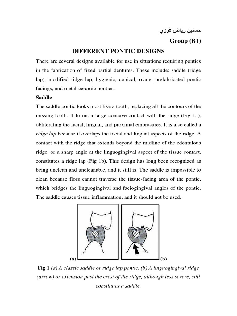 Different Pontic Design | Download Free PDF | Dentures | Mouth