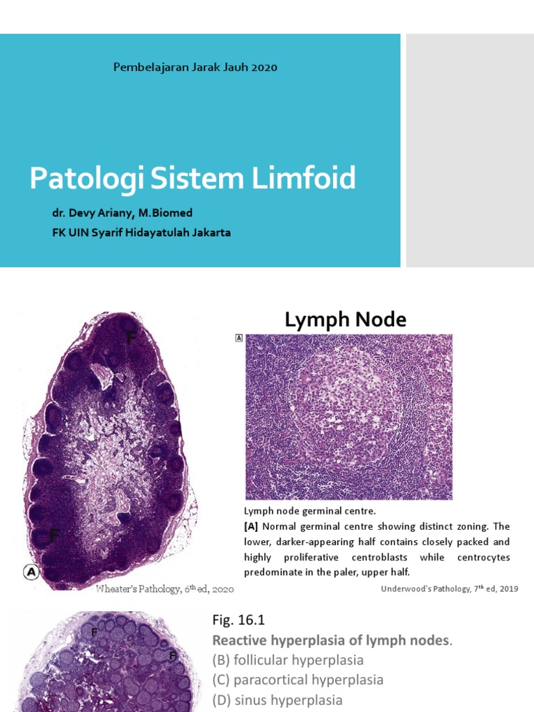 Patologi Sistem Limfoid | PDF | Lymph Node | Lymphatic System