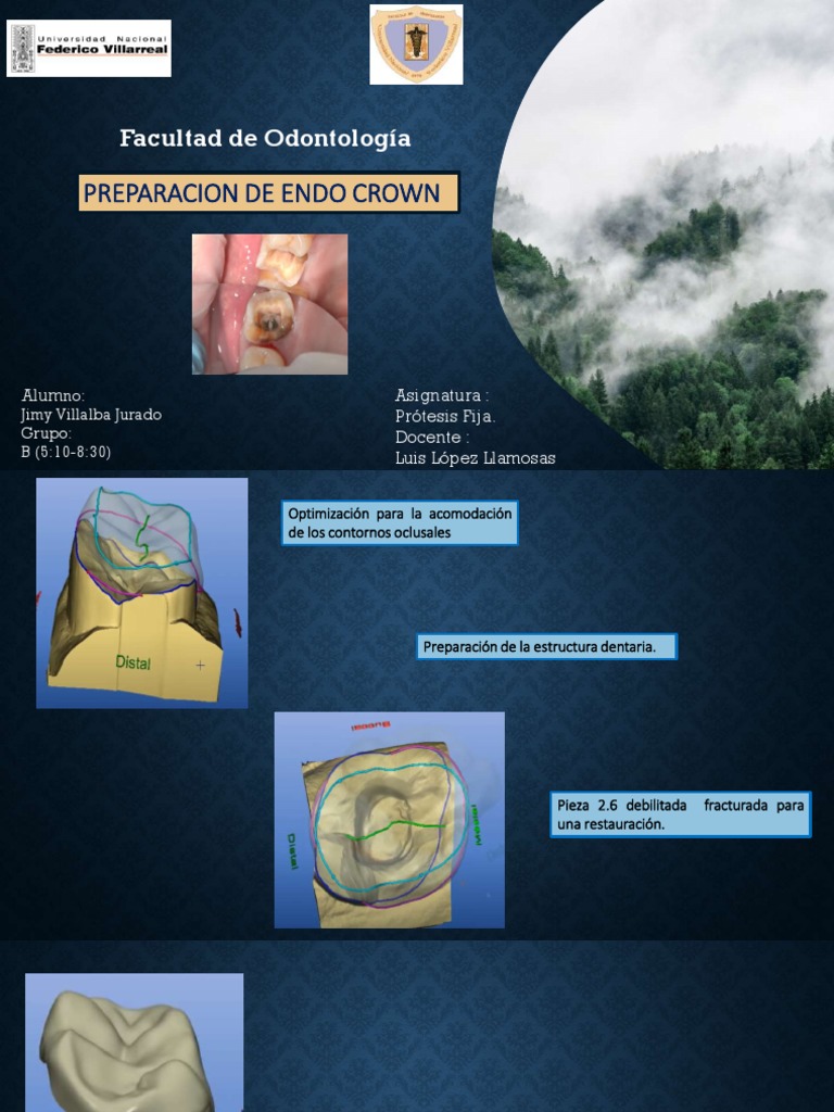 Endocrown PDF | PDF
