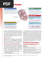 Atrial Fibrillation:Flutter in Pre-Excitation - LITFL - ECG Library ...