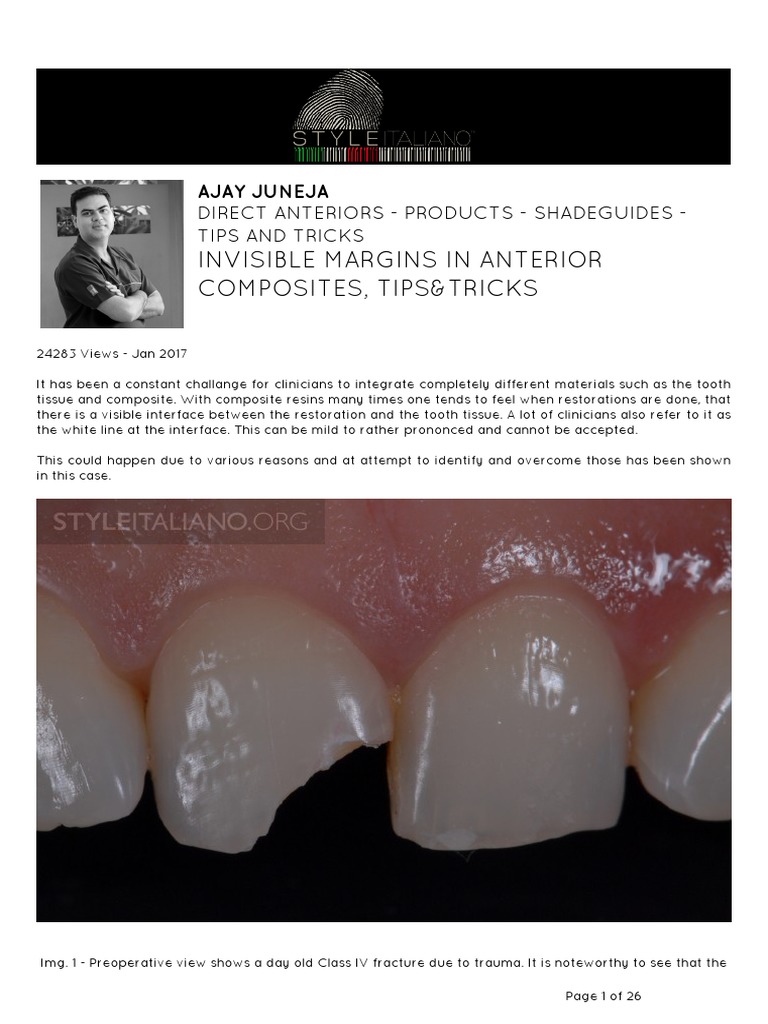 Invisible Margins in Anterior Composites, Tips&Tricks | PDF | Tooth ...