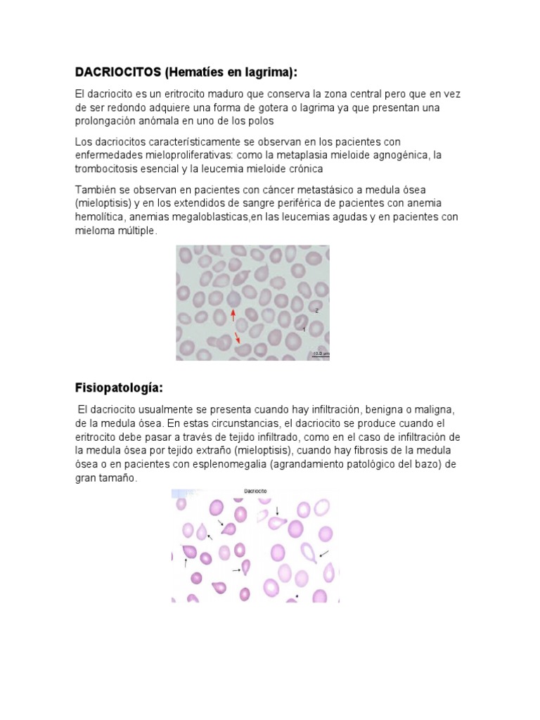 DACRIOCITOS | PDF | Glóbulo rojo | Anemia