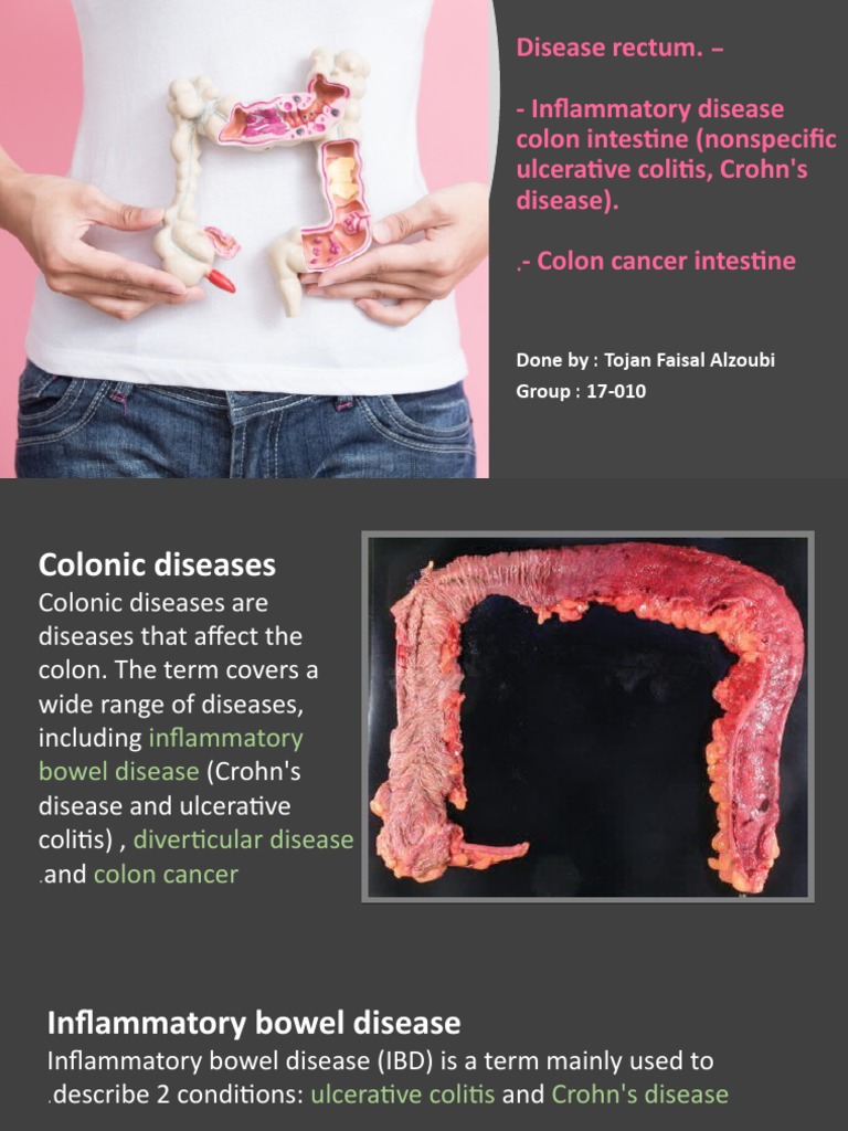 Disease Rectum. - Inflammatory Disease Colon Intestine (Nonspecific ...