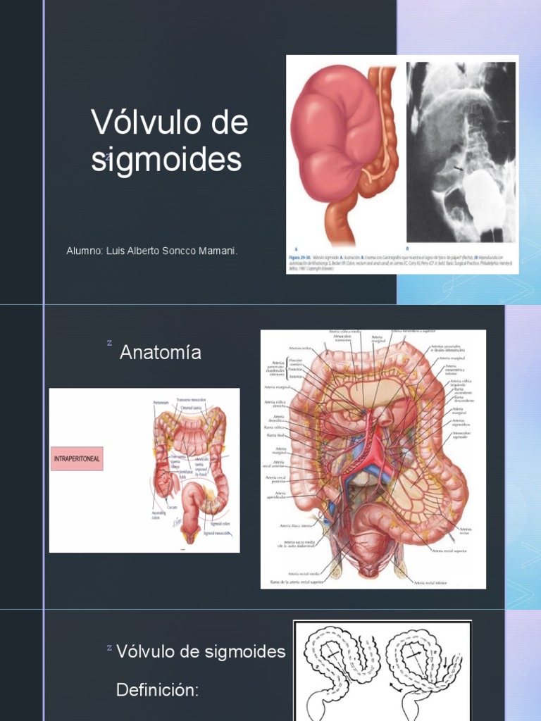 Vólvulo de Sigmoides | PDF | Medicina | Ciencias de la Salud