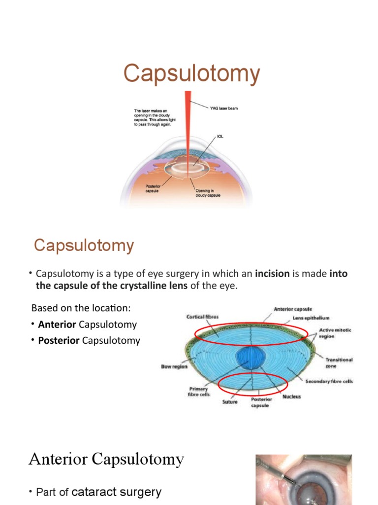 Capsulotomy | PDF | Cataract | Sensory Organs