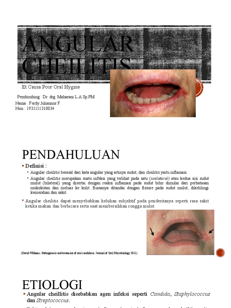 Angular Cheilitis | PDF