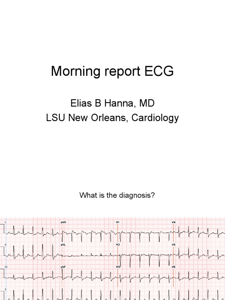 SVT Case | PDF | Physiology | Cardiac Arrhythmia