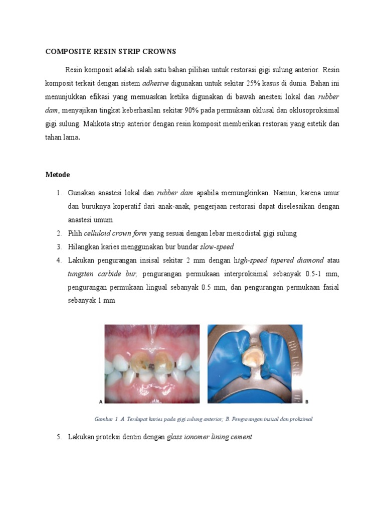 Composite Resin Strip Crowns | PDF