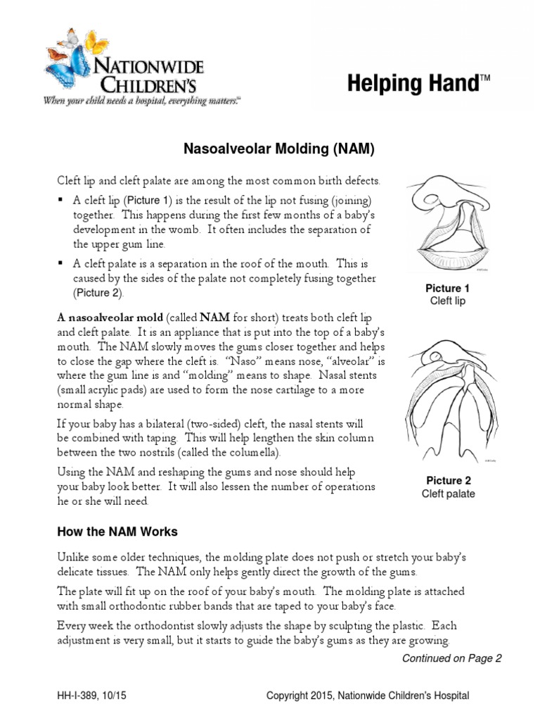 Nasoalveolar Molding (NAM) : A Nasoalveolar Mold (Called NAM For Short ...