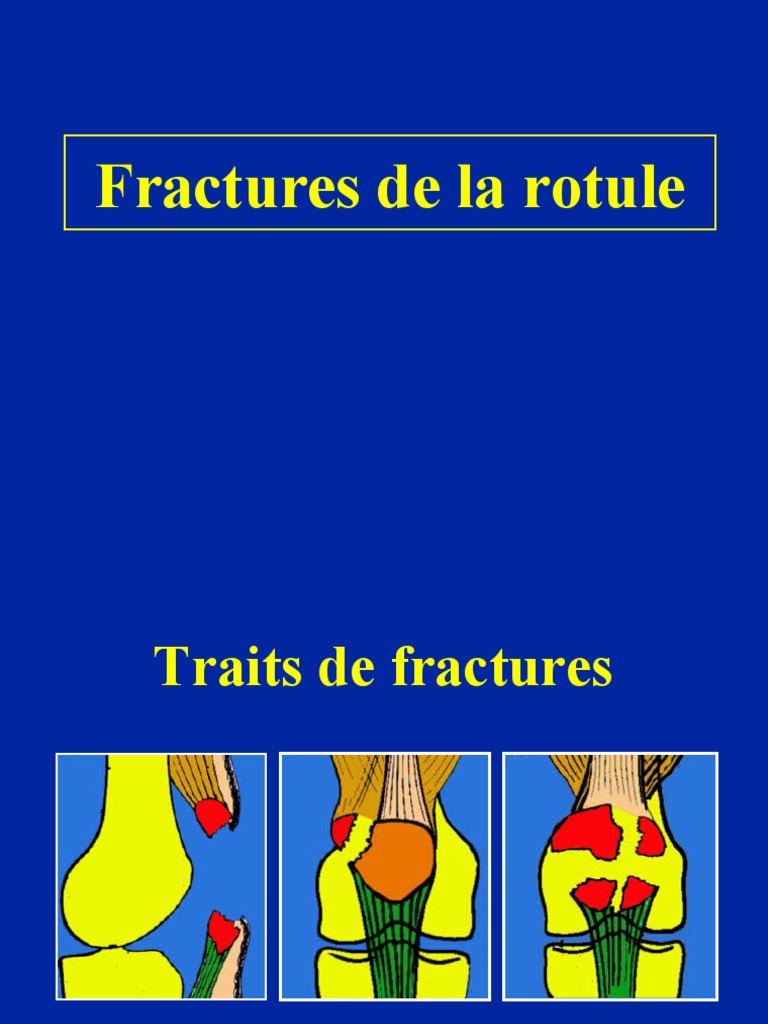 04 - Fractures de La Rotule | PDF | Appareil locomoteur | Système ...