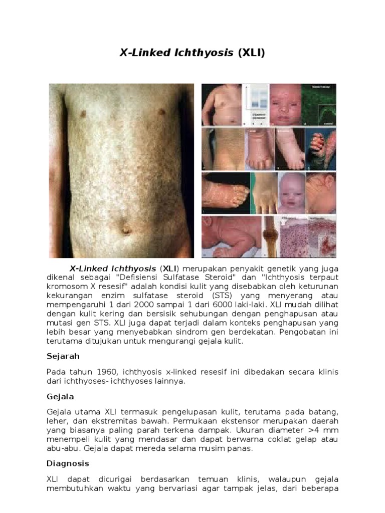X-Linked Ichthyosis | PDF