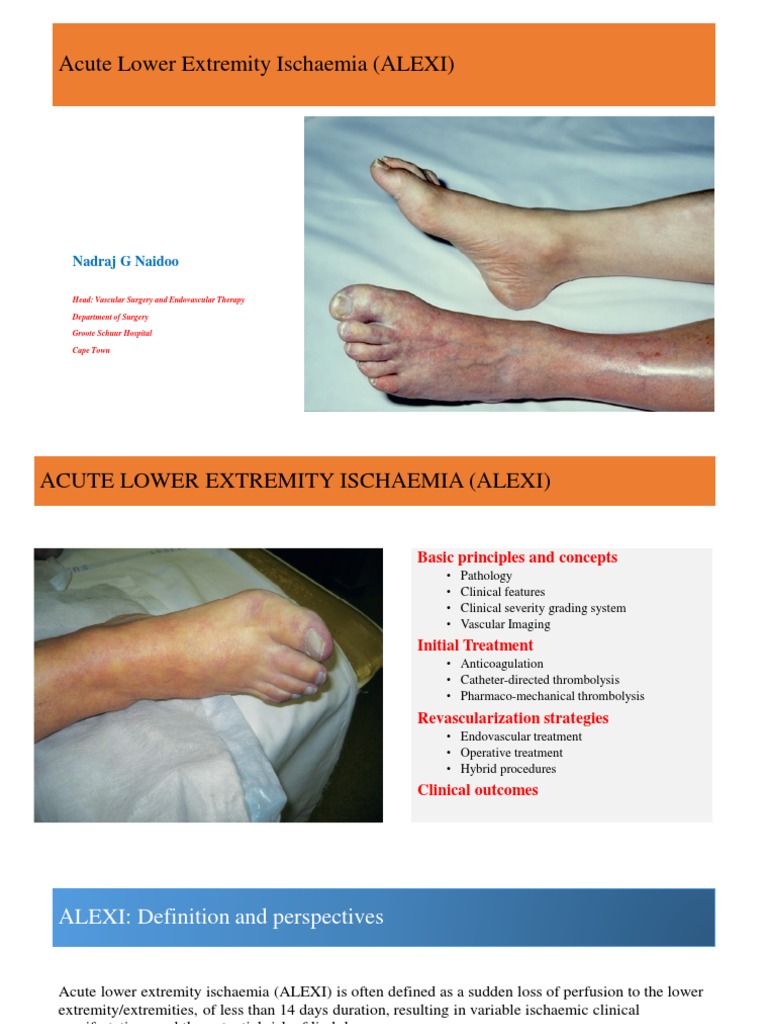 Acute Lower Extremity Ischaemia (ALEXI) : Nadraj G Naidoo | PDF ...
