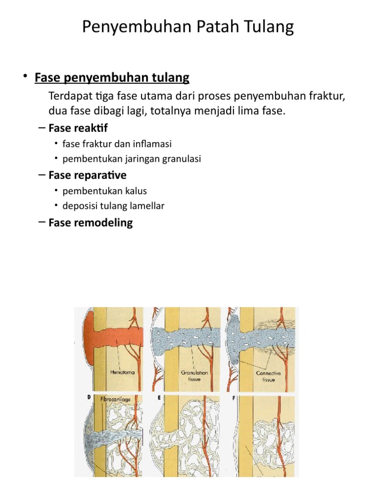 Penyembuhan Patah Tulang | PDF