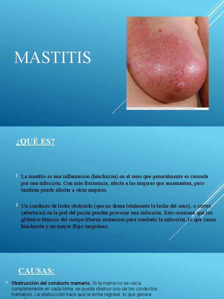 MASTITIS | PDF | Pecho | Amamantamiento