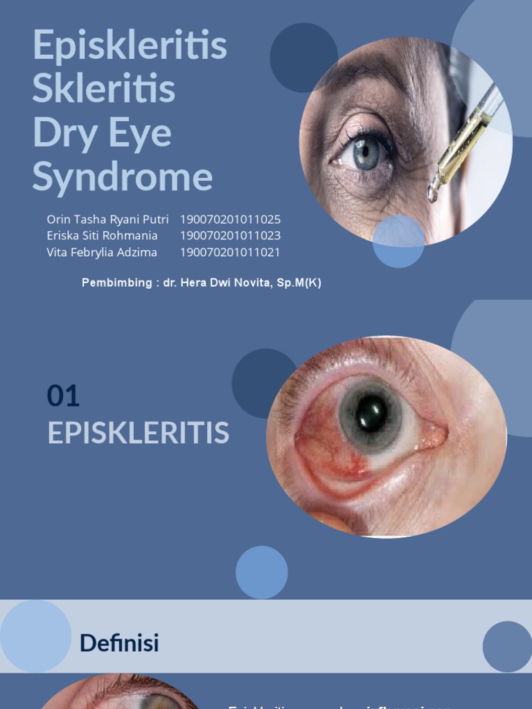 Episkleritis, Skelritis, Dan Dry Eye Syndrome | PDF