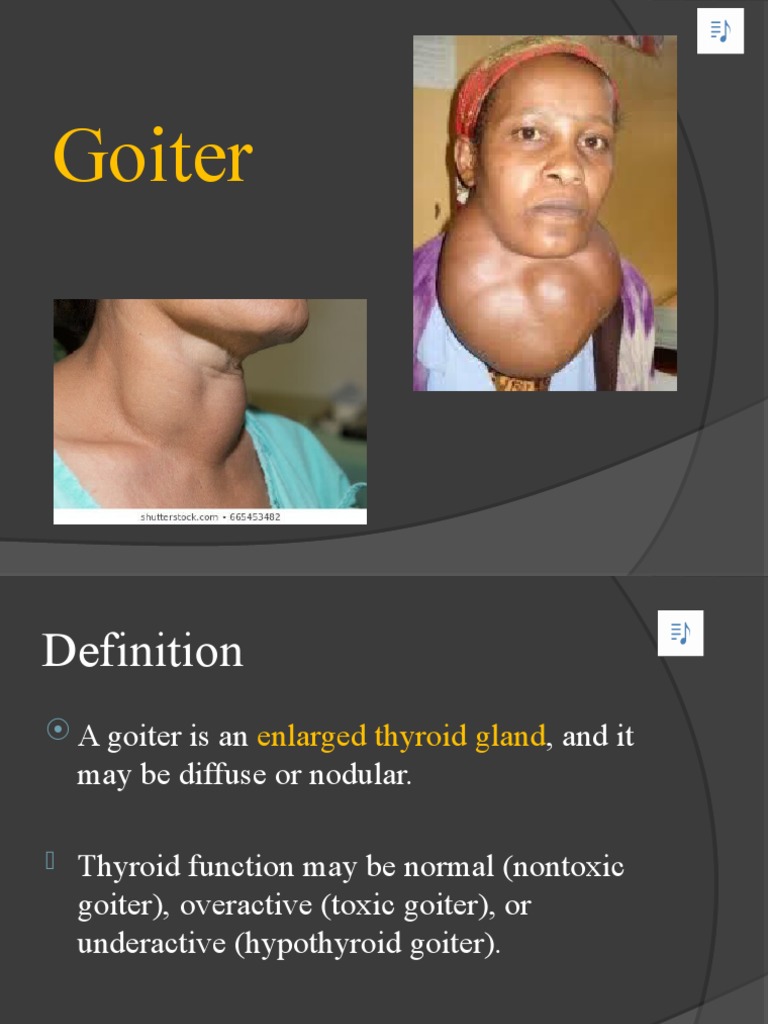 Goiter | PDF | Hypothyroidism | Thyroid Stimulating Hormone