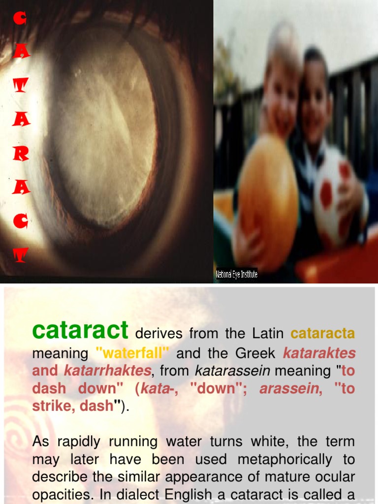 Nursing Management of Cataracts | PDF | Cataract | Ophthalmology