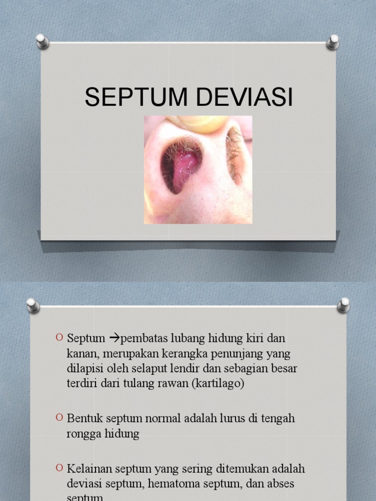 Septum Deviasi | PDF