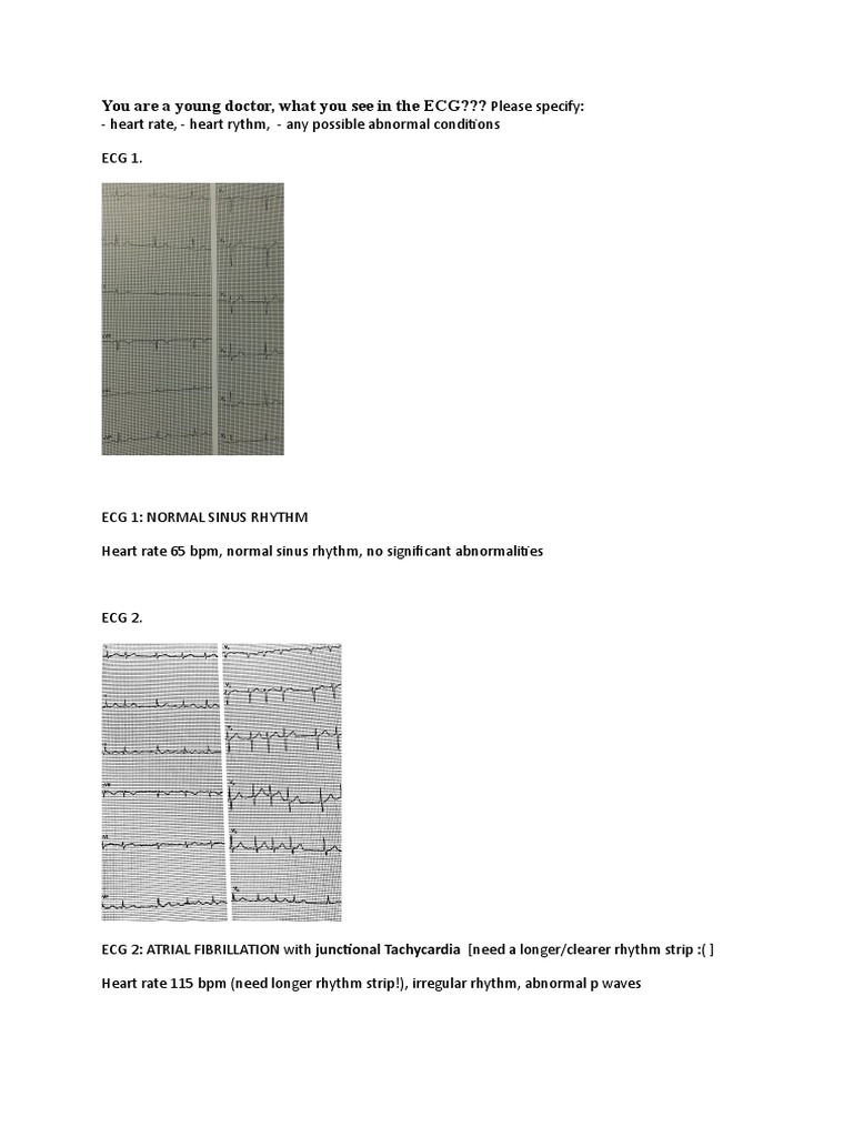 Ecg + Decision Tree | PDF