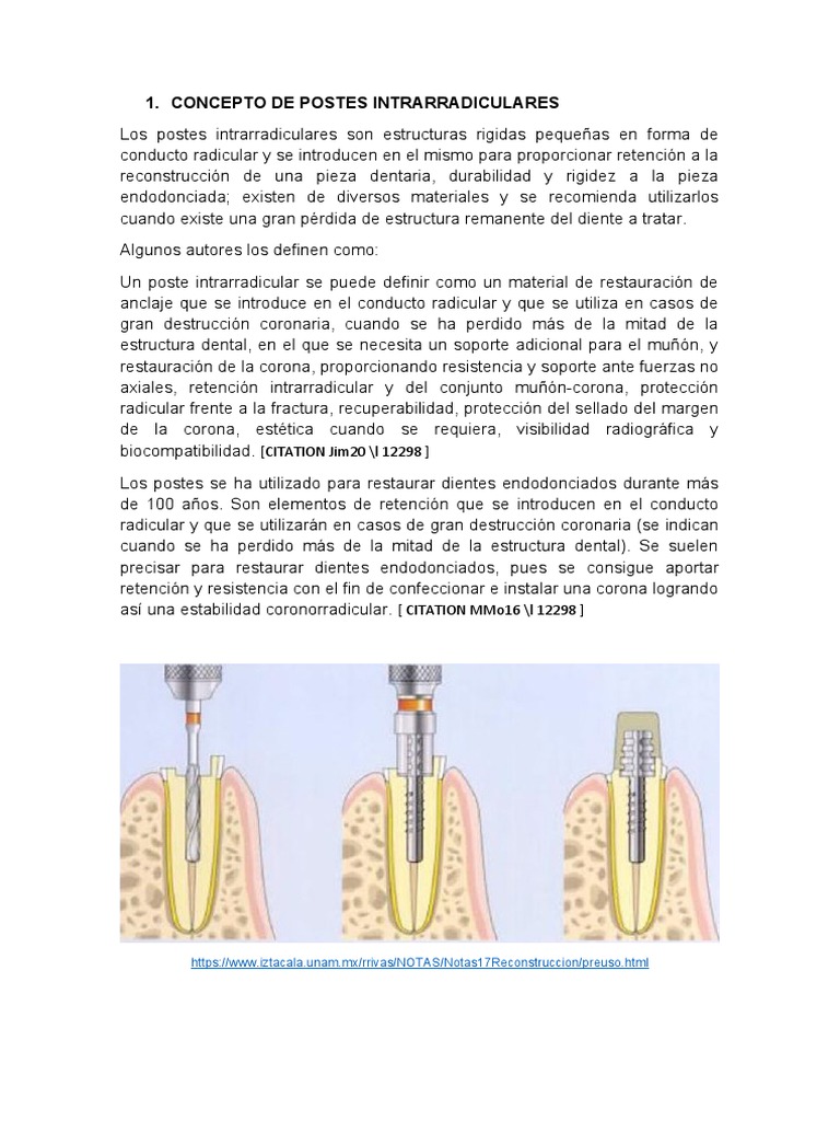 Concepto de Postes Intrarradiculares | PDF
