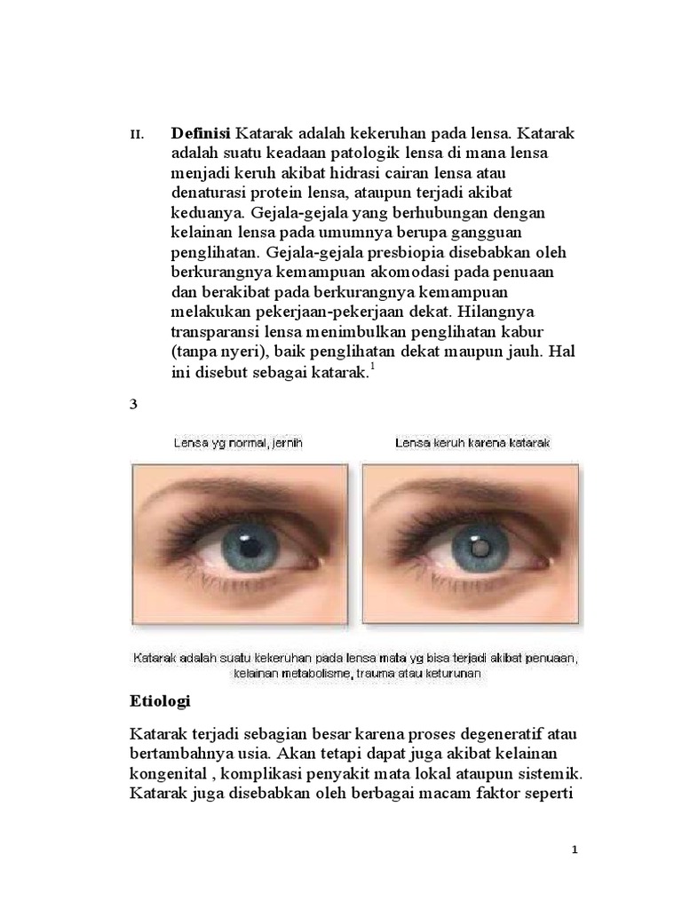 Katarak Adalah Kekeruhan Pada Lensa | PDF