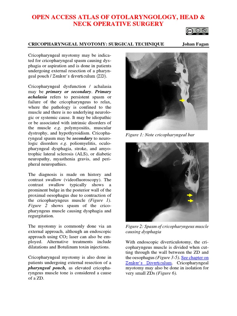Cricopharyngeal Myotomy Surgical Technique | PDF | Common Carotid ...