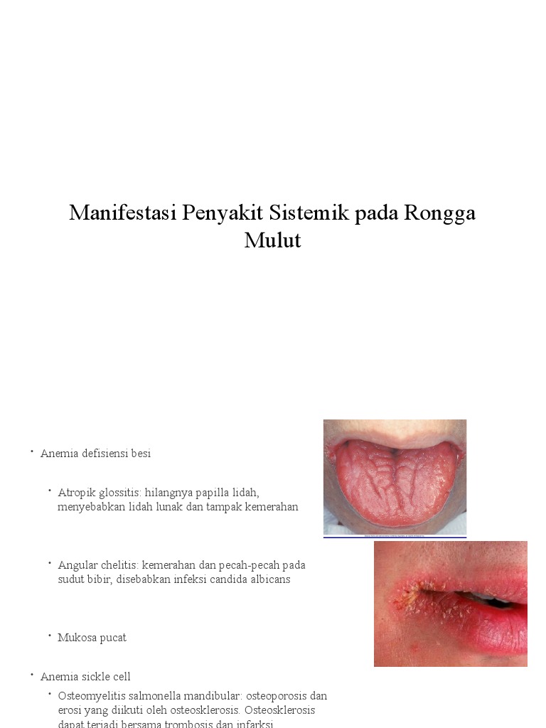 Manifestasi Penyakit Sistemik Pada Rongga Mulut | PDF | Perjalanan ...