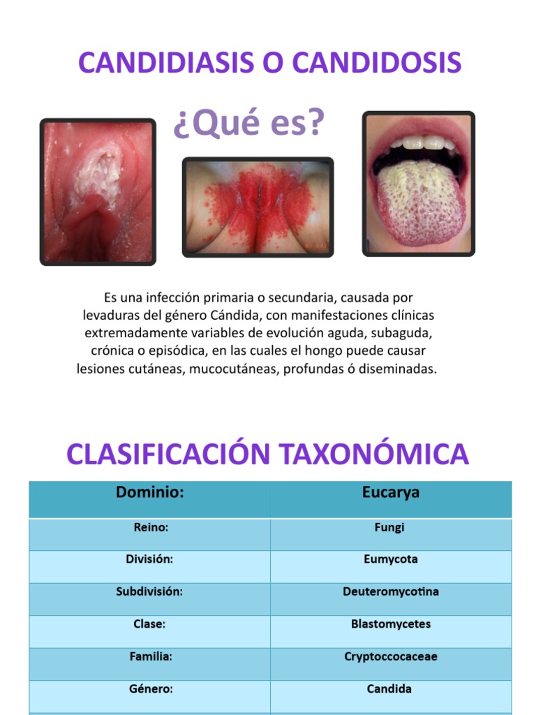 Candidiasis: Clasificación y Tratamiento | PDF | Candidiasis ...