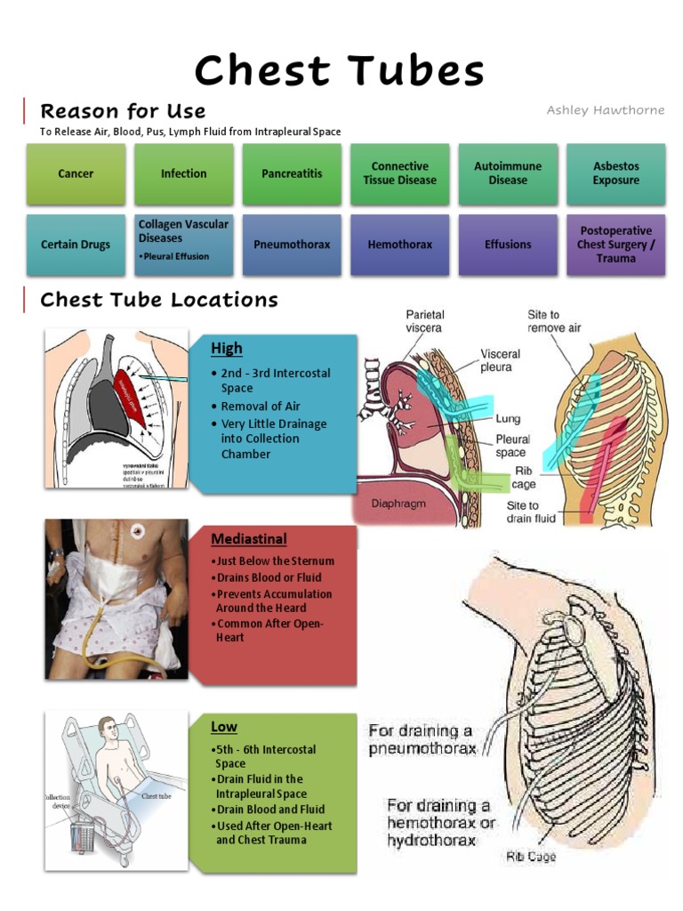 [TITLE] Chest Tube Insertion: A Comprehensive Guide to Placement ...