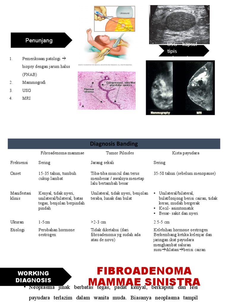 Fibroadenoma Mammae | PDF