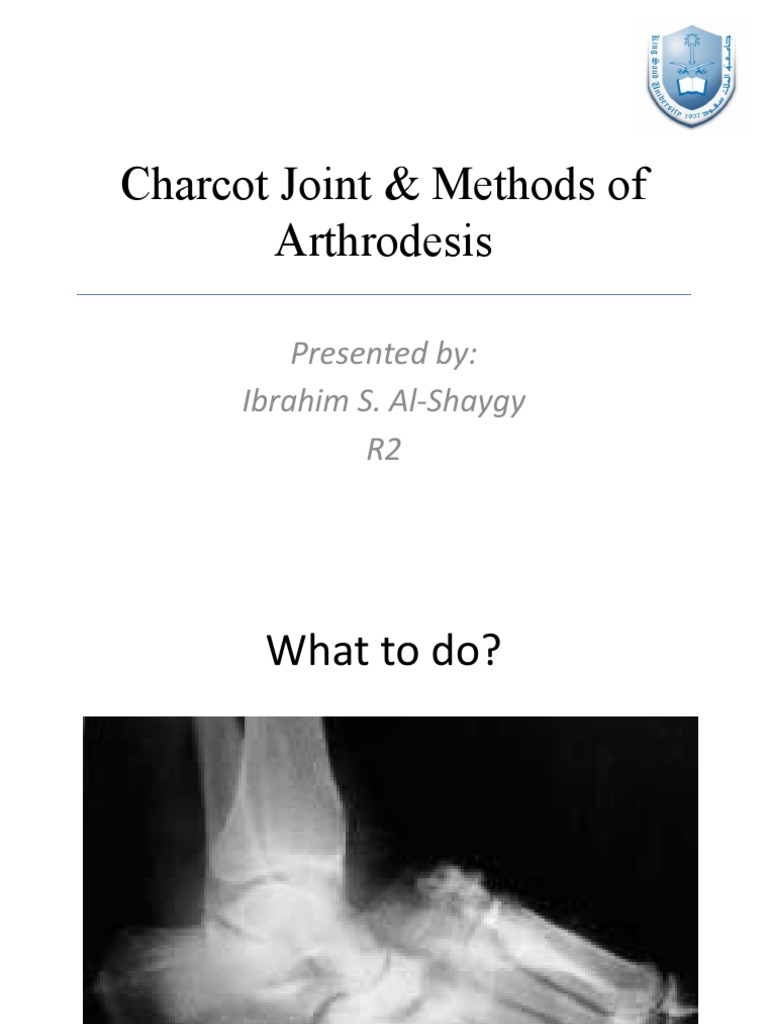 Charcot Joint & Methods of Arthrodesis | PDF | Musculoskeletal System ...