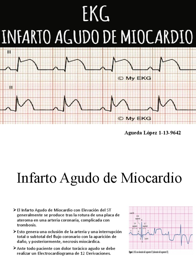 Infarto Agudo de Miocardio y EKG | PDF | Infarto de miocardio ...