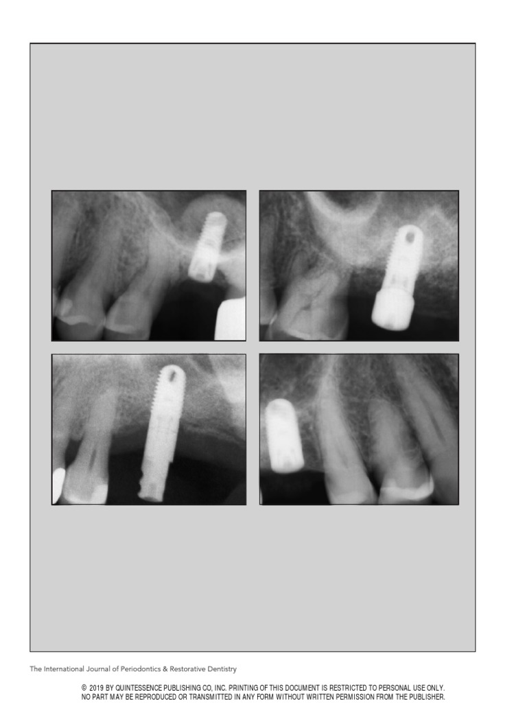 The International Journal of Periodontics & Restorative Dentistry | PDF ...
