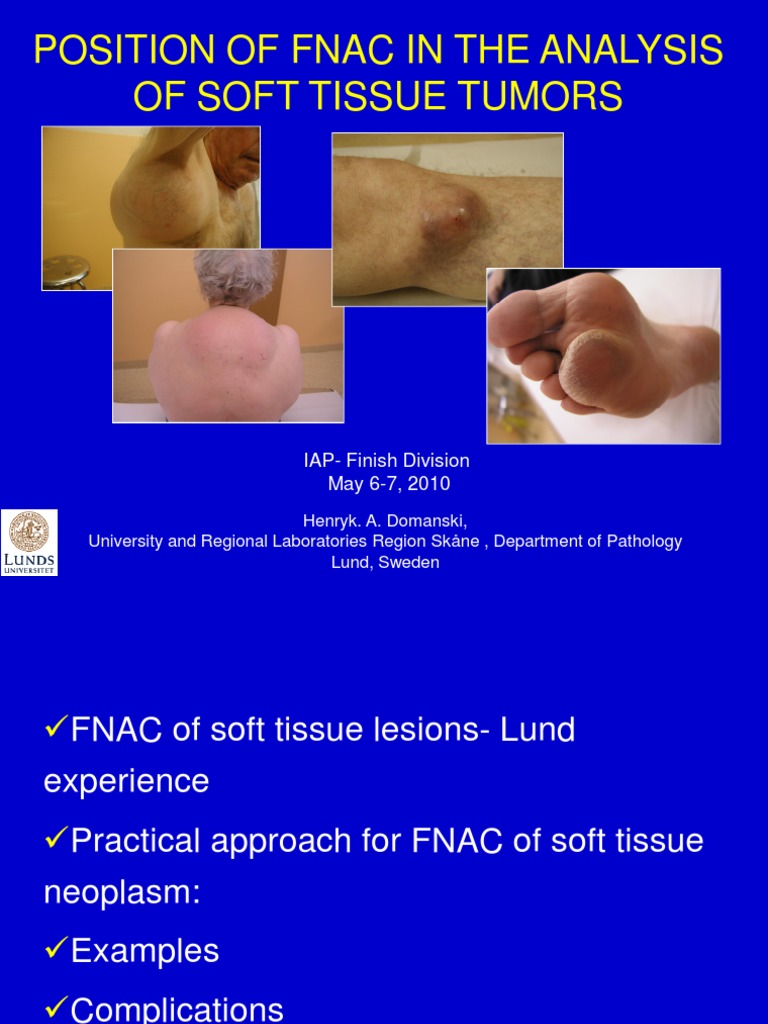 FNA Soft TX Tu | PDF | Sarcoma | Cytopathology