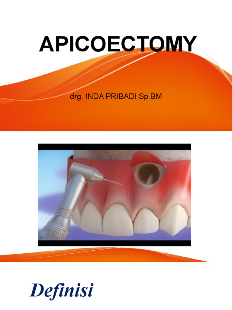 Apicoectomy 2 | PDF