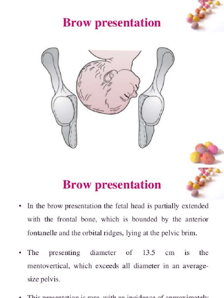 Brow Presentation | PDF