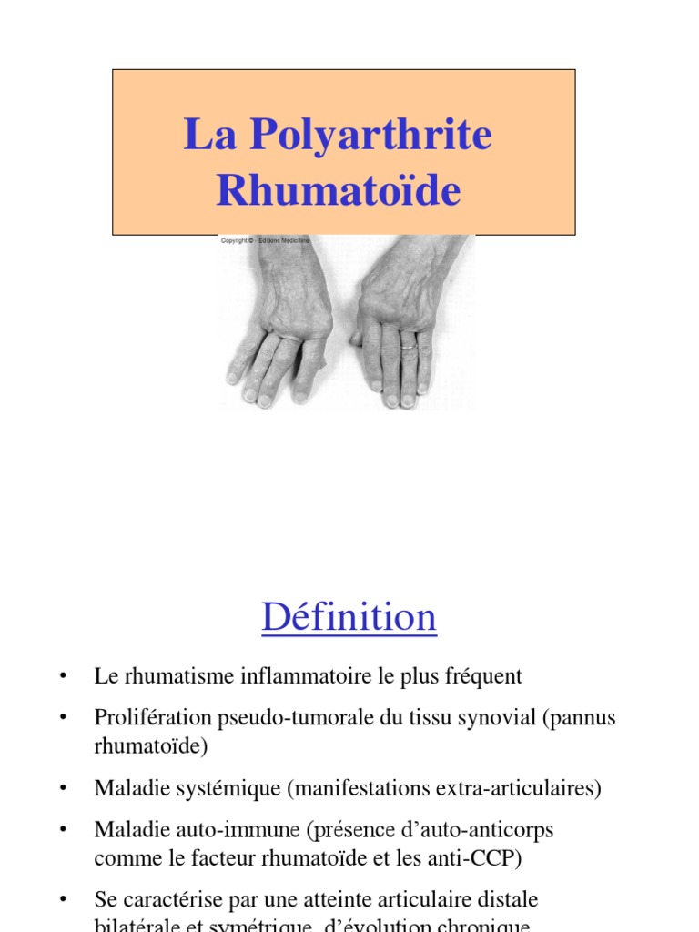 Polyarthrite Rhumatoïde : Définition et Évolution | PDF | Système ...