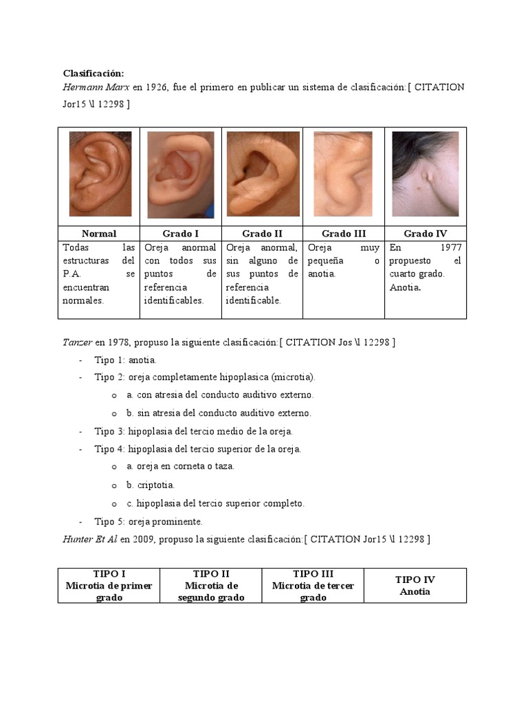 microtia clasificación | PDF | Hueso | Oído