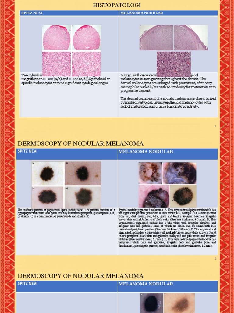 Spitz Nevi Dan Nodular Melanoma | PDF | Melanoma | Neoplasms
