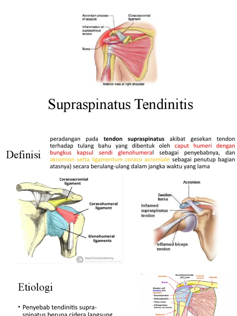 Supraspinatus Tendinitis | PDF