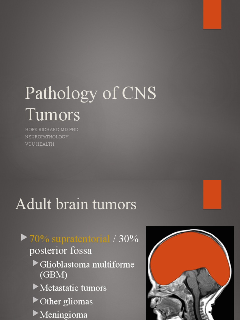 CNS Tumors Neurology | PDF | Brain Tumor | Human Diseases And Disorders
