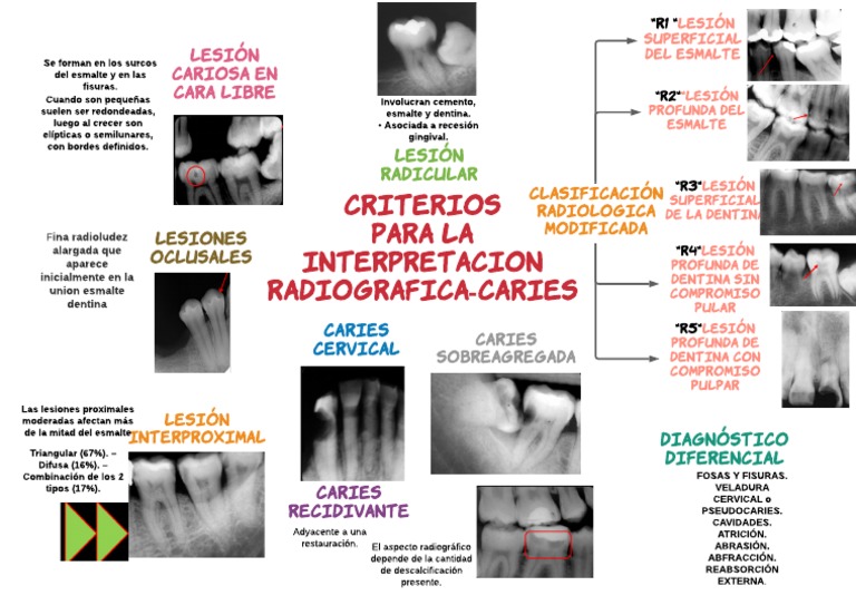Caries RX | PDF | Esmalte de dientes | Diente