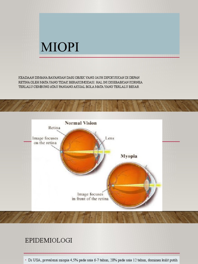 Miopi: Pengertian dan Epidemiologi | PDF | Pengembangan Diri ...