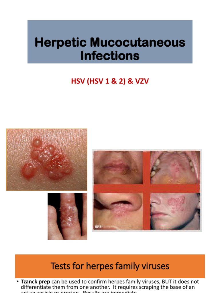 Herpetic Mucocutaneous Infections: HSV (HSV 1 & 2) & VZV | PDF | Herpes ...