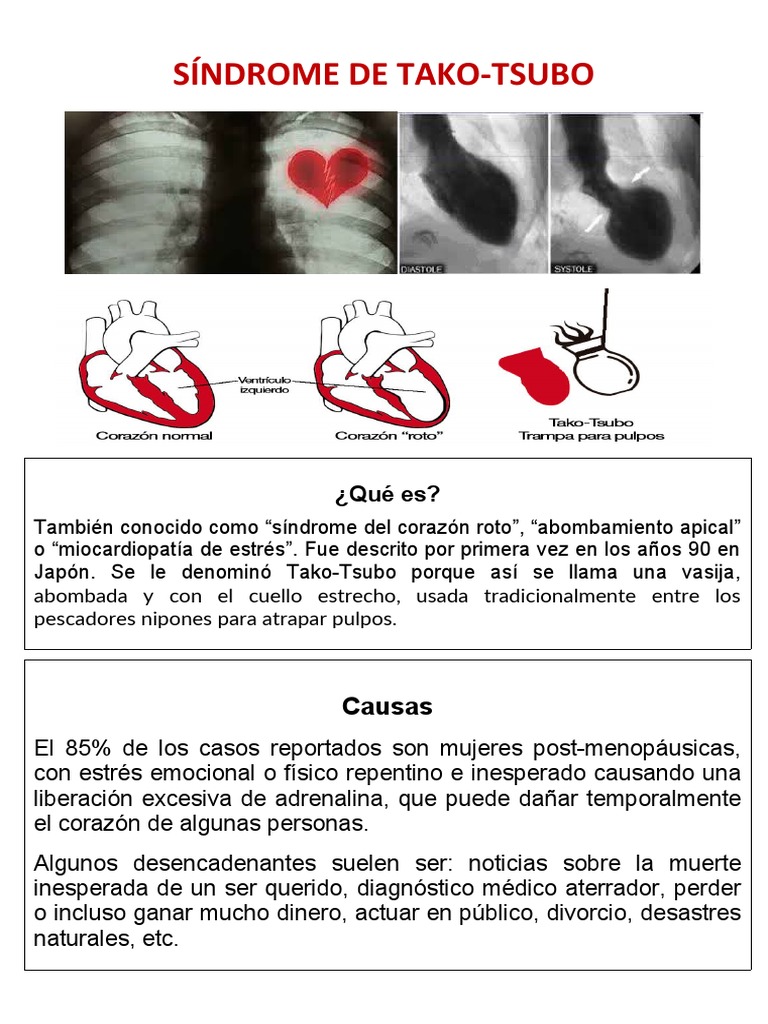 Síndrome de Tako | PDF | Infarto de miocardio | Músculo cardíaco