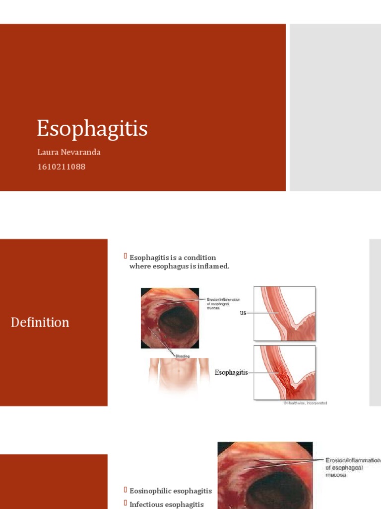 A Comprehensive Overview of Eosinophilic Esophagitis: Definition, Types ...