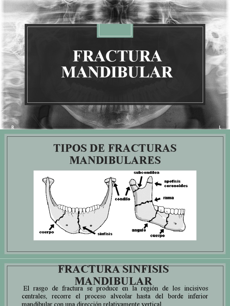Fractura Mandibular | PDF | Cara | Sistema musculoesquelético