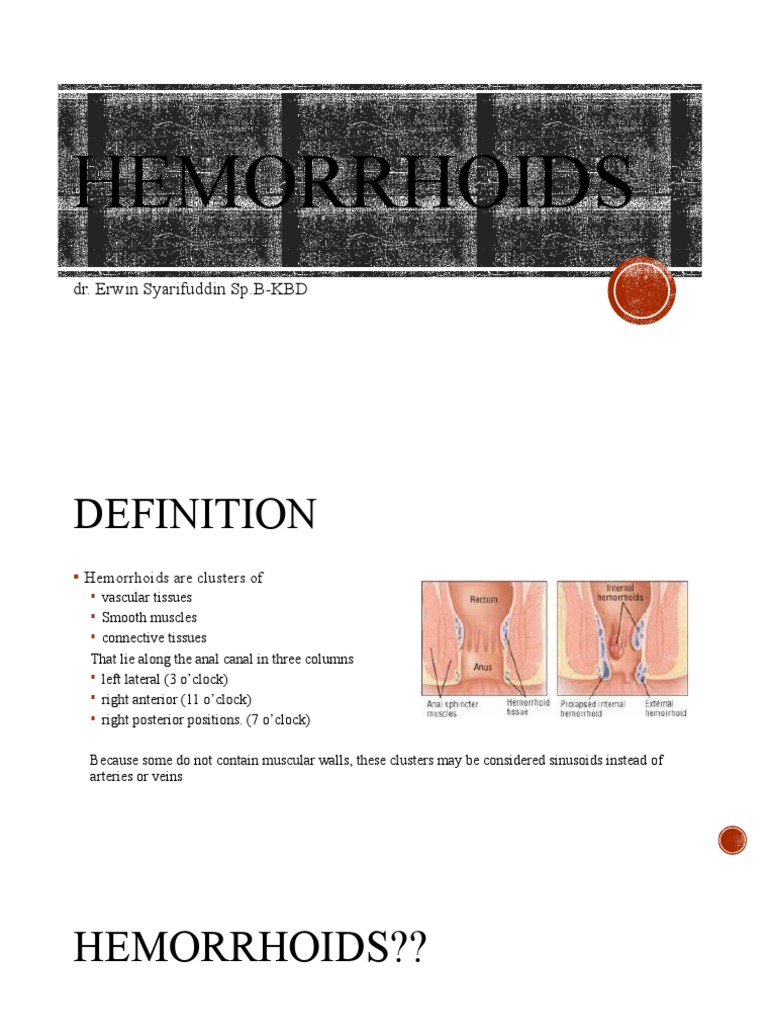 Hemorrhoids Treatment Guide | PDF | Hemorrhoid | Clinical Medicine
