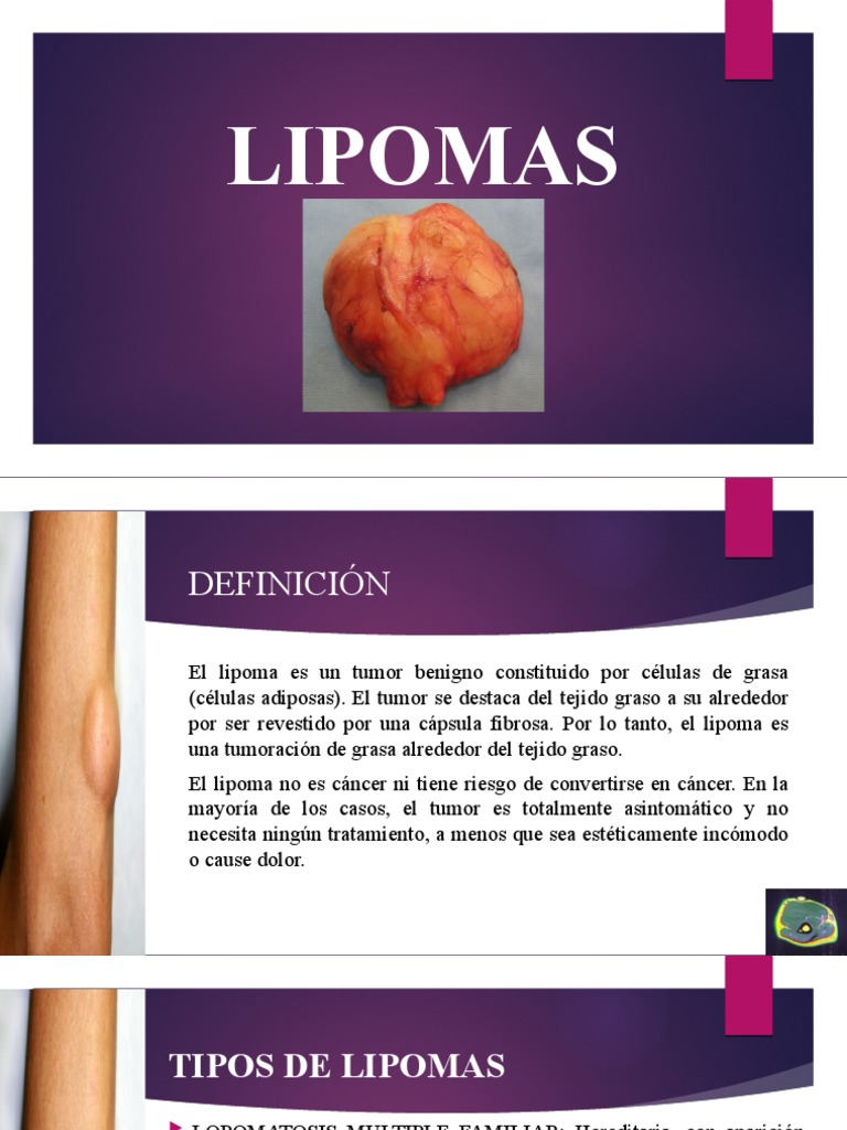 LIPOMAS | PDF | Especialidades Medicas | Medicina CLINICA