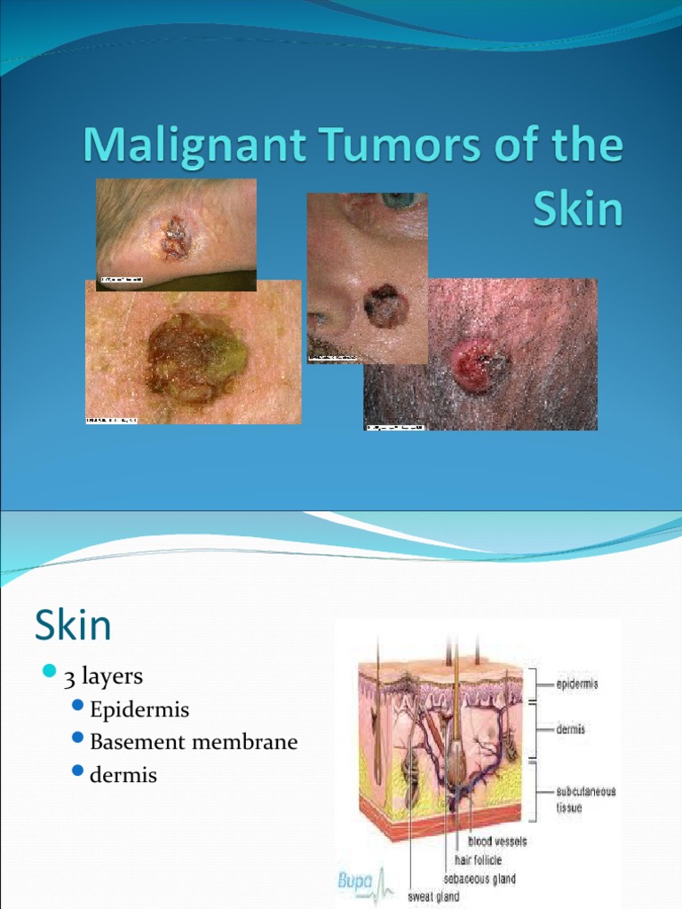 Malignant Tumors of The Skin | PDF | Carcinoma | Neoplasms